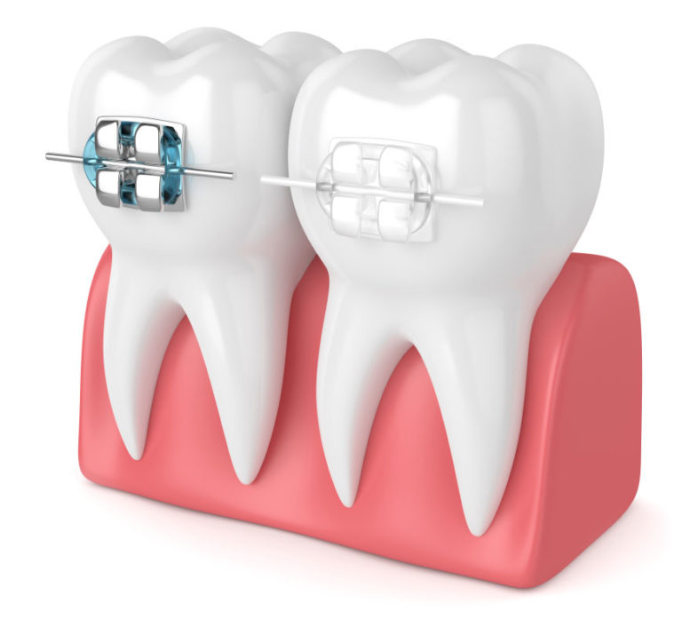 Orthodontics for Teens| VanderWall Orthodontics | Braces & Invisalign ...